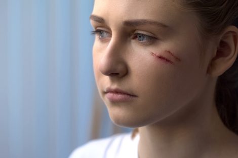 Facial Injuries Caused By Car Accidents — Cellino Law